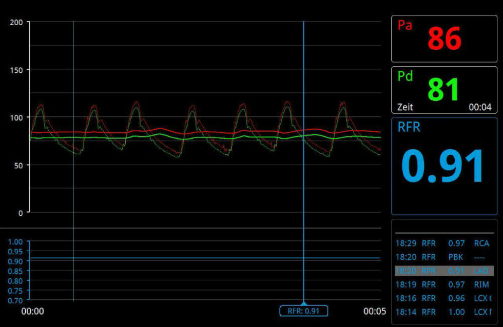 Quantifizierung der Stenose | komplexepci-hessen.de